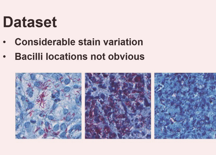 Segmentation of mycobacterium tuberculosis bacilli clusters from acid ...